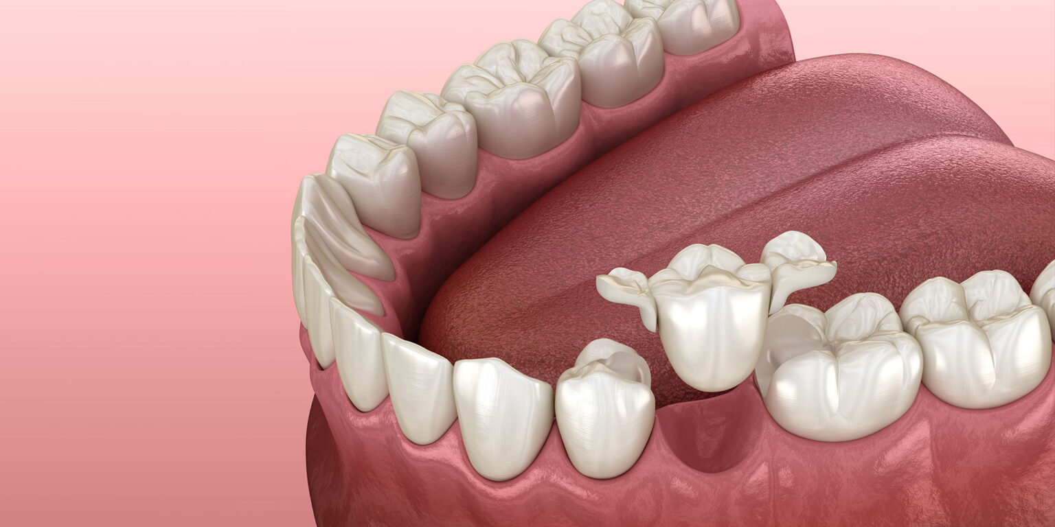 Biomimetic Restoration | Coral Springs, FL | Alpha Dental Practice