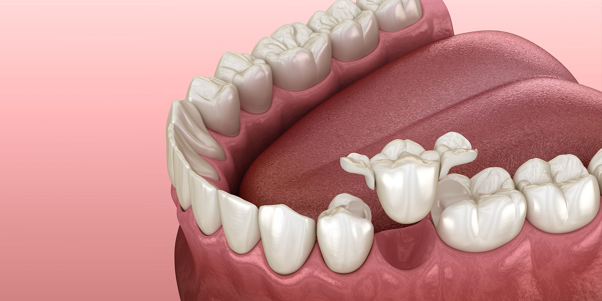 Biomimetic Restoration | Coral Springs, FL | Alpha Dental Practice